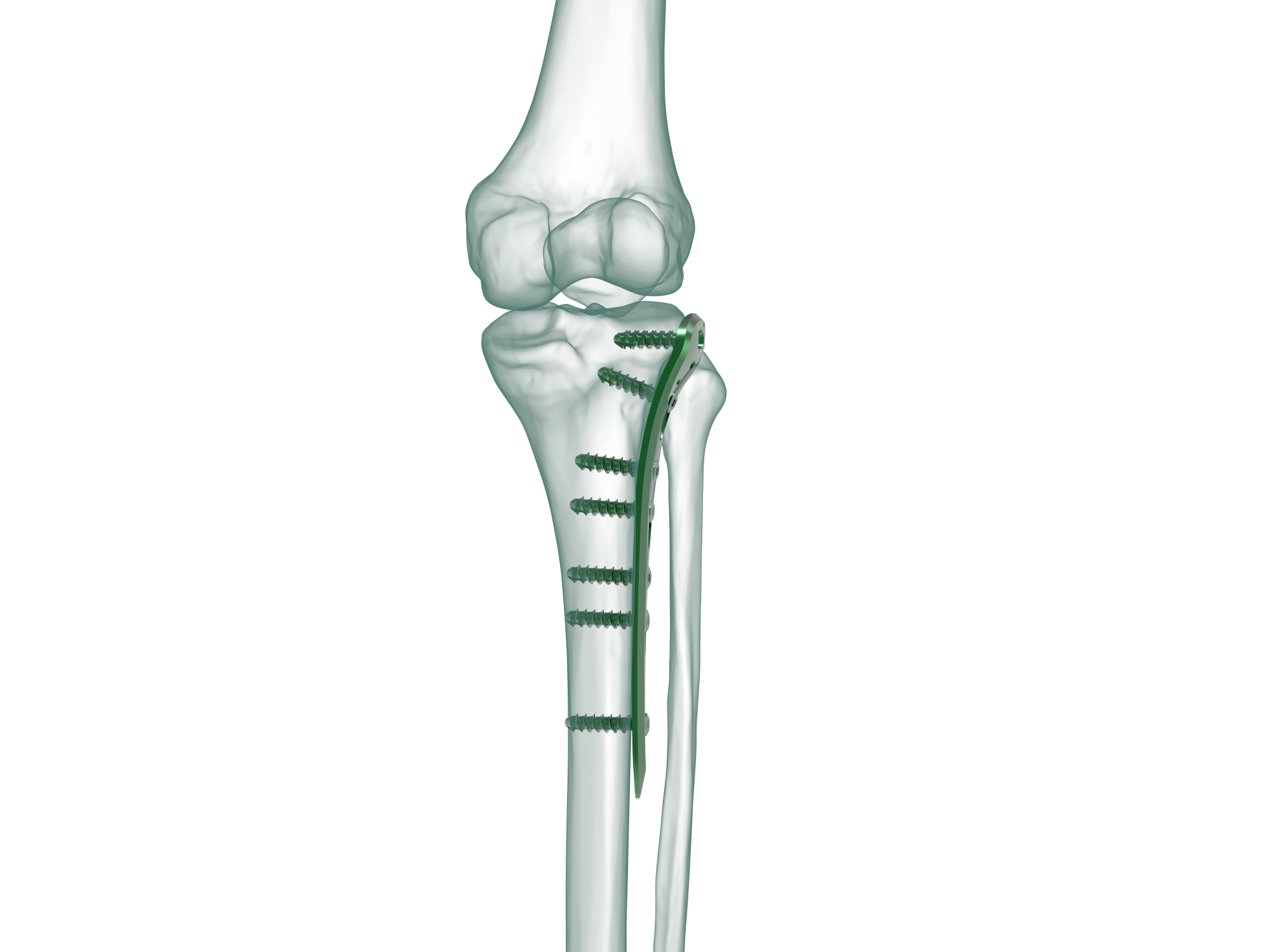 TRUE LOCK 4.5mm Proximal Tibia Lateral Anatomic Plate | TRUEMED Medikal