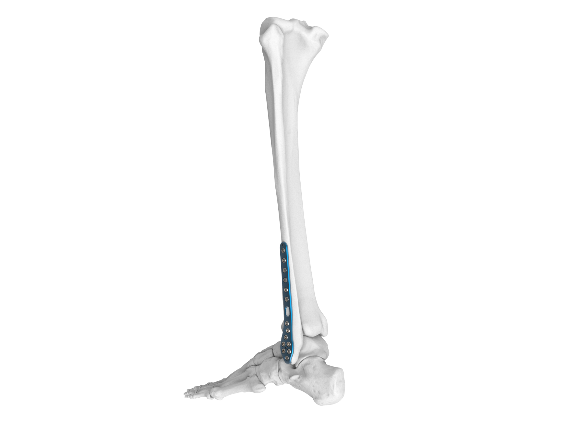 TRUE LOCK Distal Fibula Plate | TRUEMED Medikal